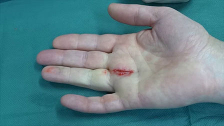 Fallbeispiele zur WALANT Chirurgie